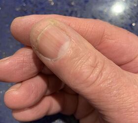 A Simple Inexpensive Winter Treatment for Dry, Cracked Fingertips ...